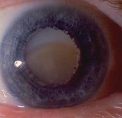 Medicine Decoded: Cataracts-Few interesting types